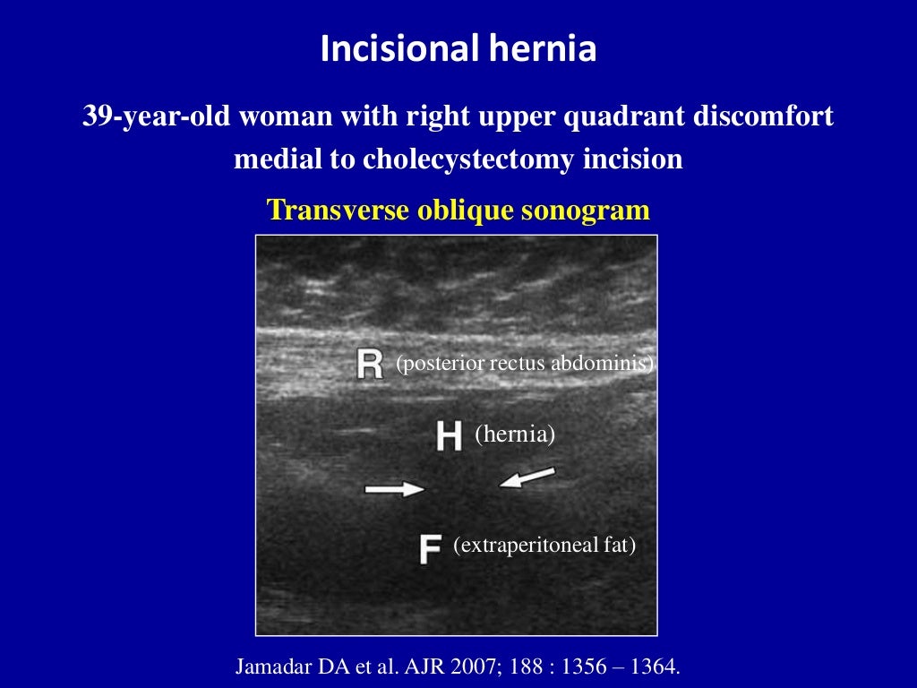 Ultrasound of the abdominal wall hernias