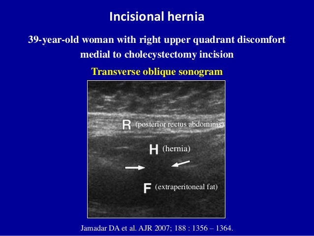 Ultrasound of the abdominal wall hernias