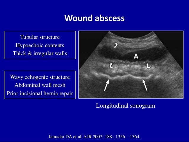 Ultrasound of the abdominal wall hernias