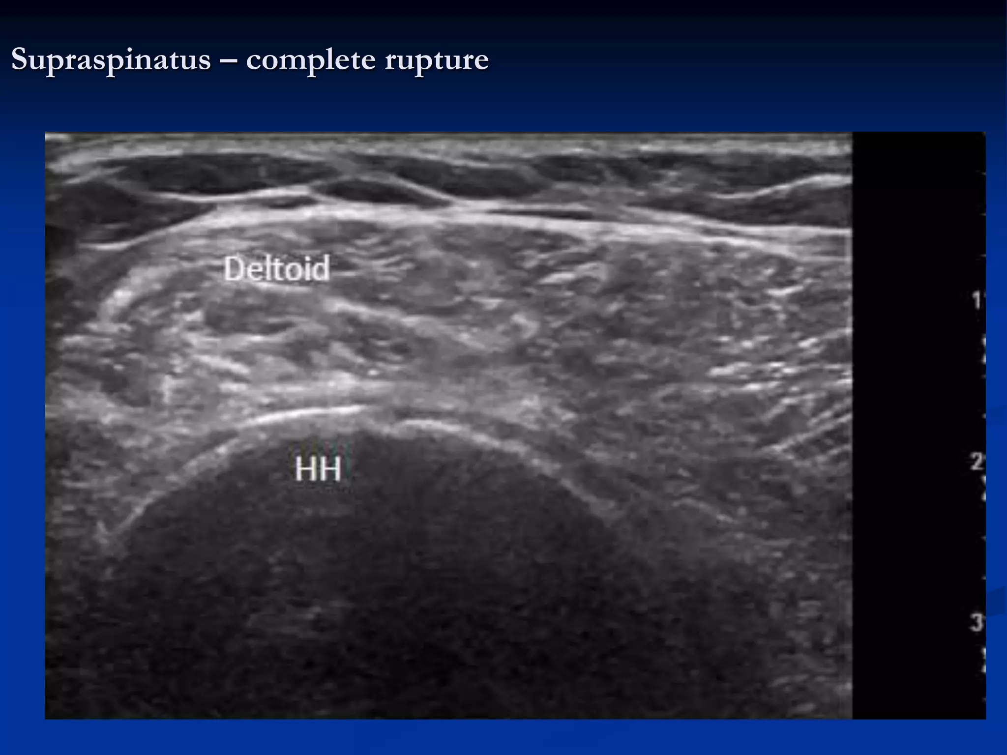 Post-graduate Certifcate Musculoskeletal Ultrasound - The Shoulder ...