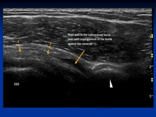 Post-graduate Certifcate Musculoskeletal Ultrasound - The Shoulder | PPTX