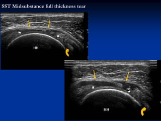 Post-graduate Certifcate Musculoskeletal Ultrasound - The Shoulder | PPTX