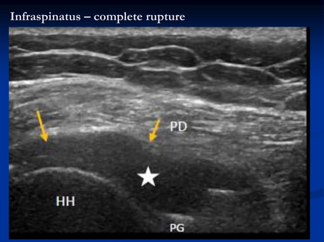 Post-graduate Certifcate Musculoskeletal Ultrasound - The Shoulder | PPT