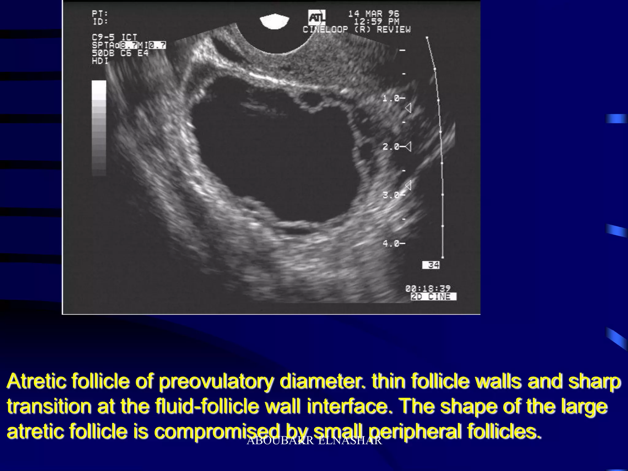 Ultrasonography of the ovary | PDF