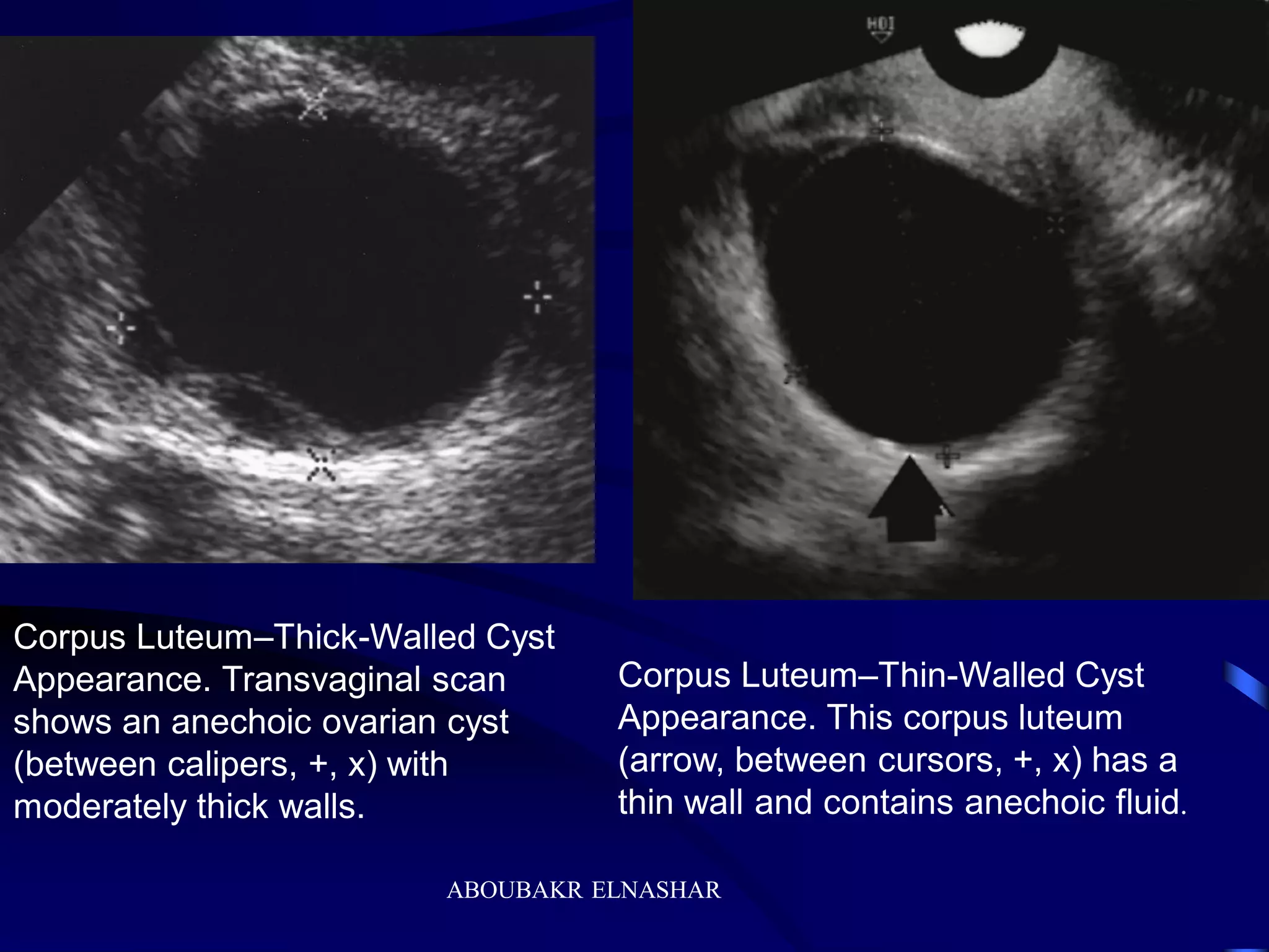 Ultrasonography of the ovary | PDF