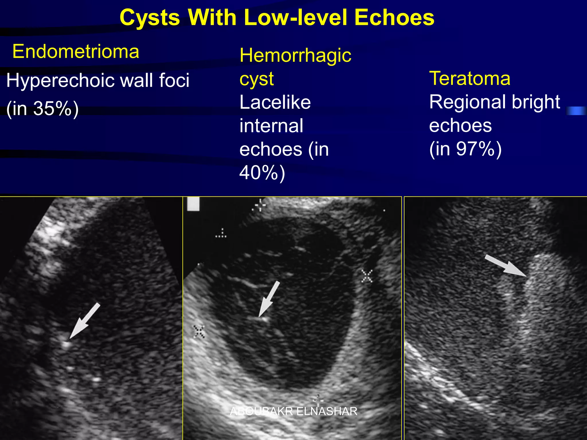 Ultrasonography of the ovary | PDF