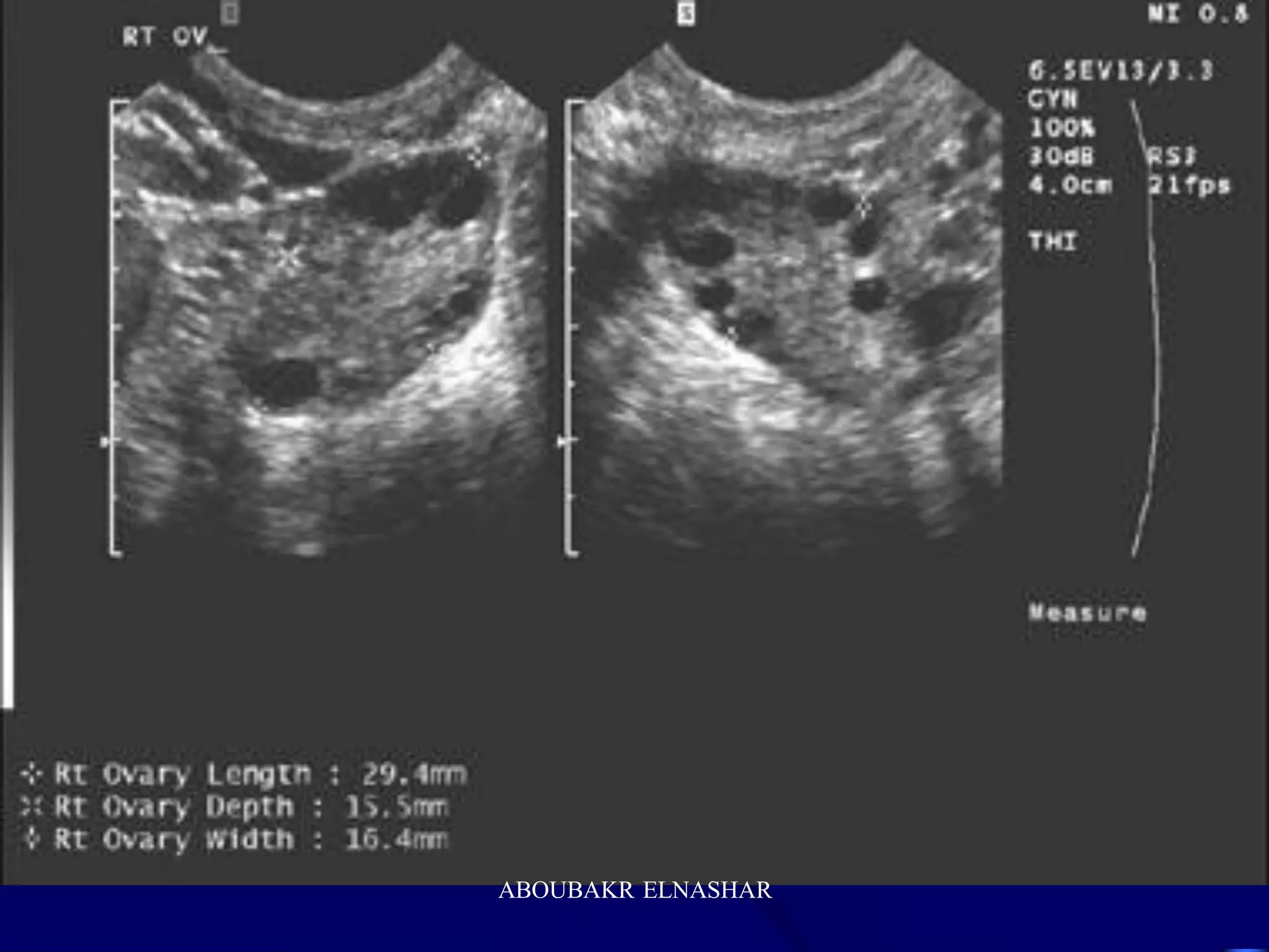 Ultrasonography of the ovary | PDF