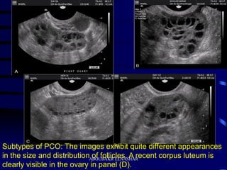 Normal Ovary Ultrasound