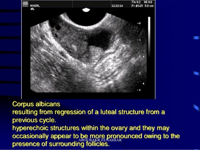 Ultrasonography of the ovary