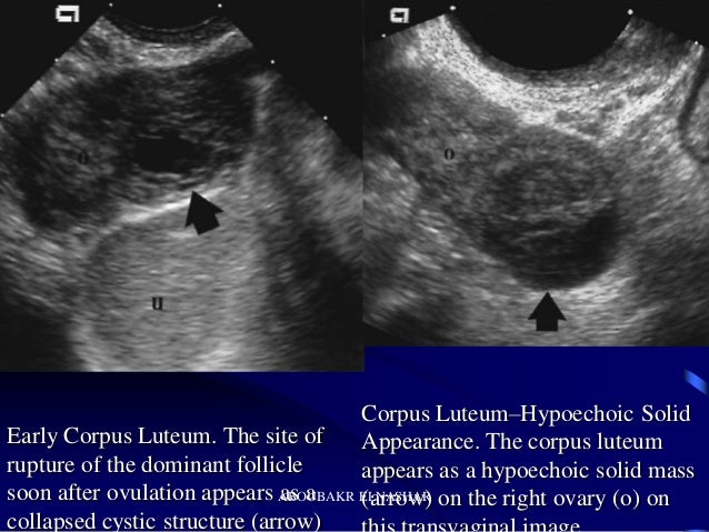 Ultrasonography of the ovary