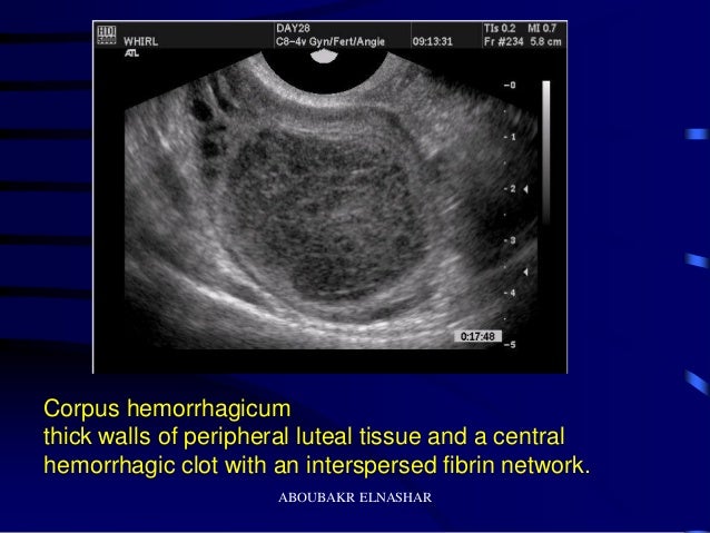 Ultrasonography of the ovary