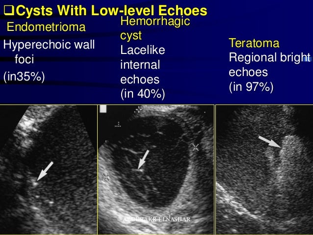 Ultrasonography of the ovary