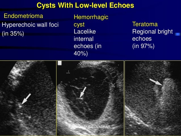 Ultrasonography of the ovary