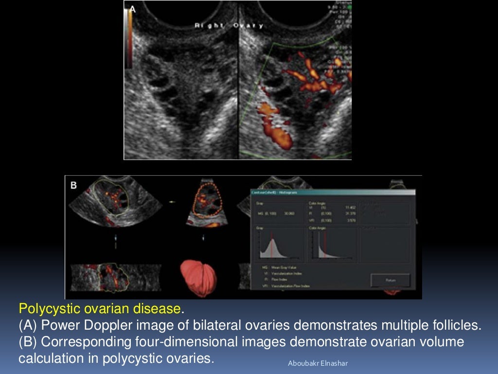 Sonographic Evaluation of Pelvic Masses