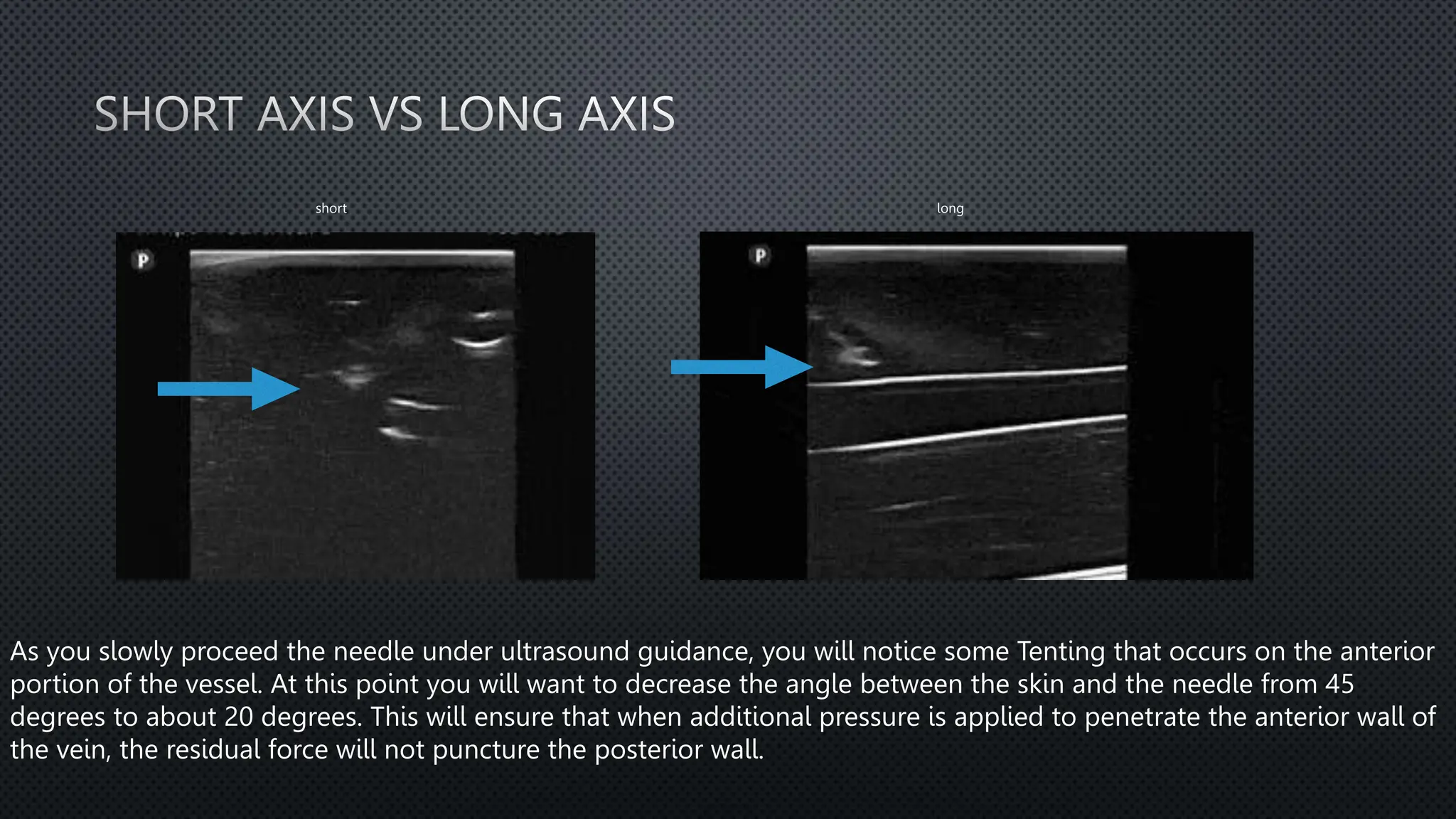 Peripheral IV placement under ultrasound guidance | PPTX
