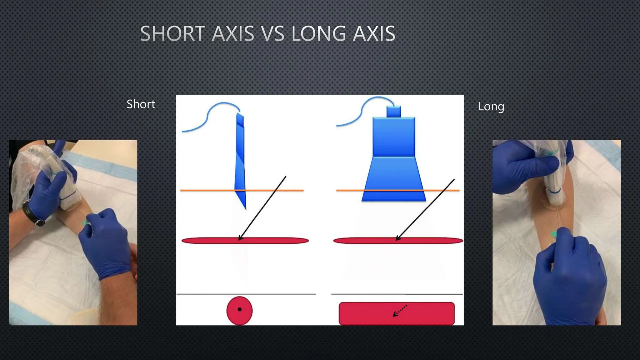 Peripheral IV placement under ultrasound guidance | PPTX