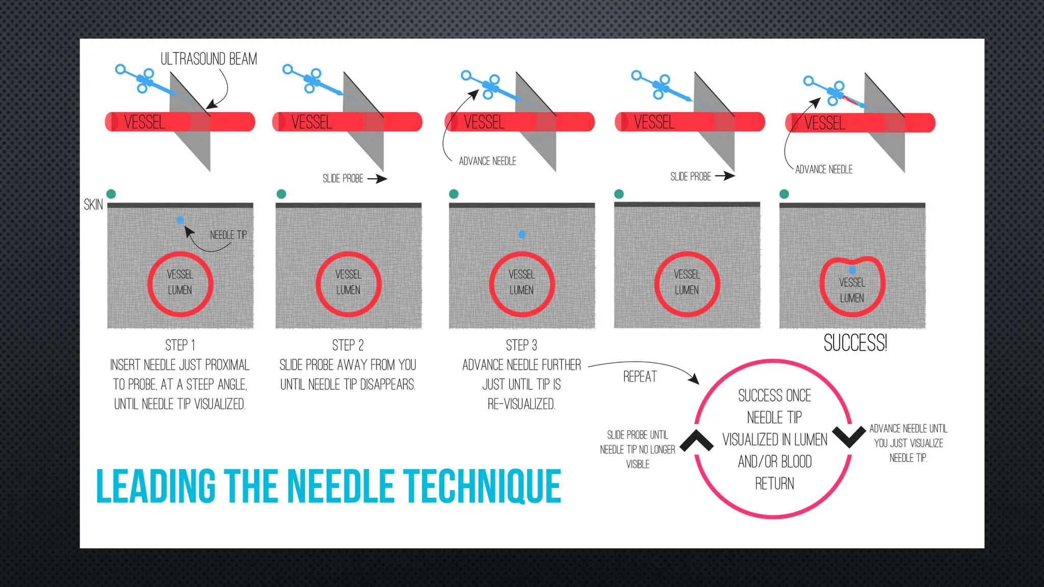 Peripheral IV placement under ultrasound guidance | PPTX