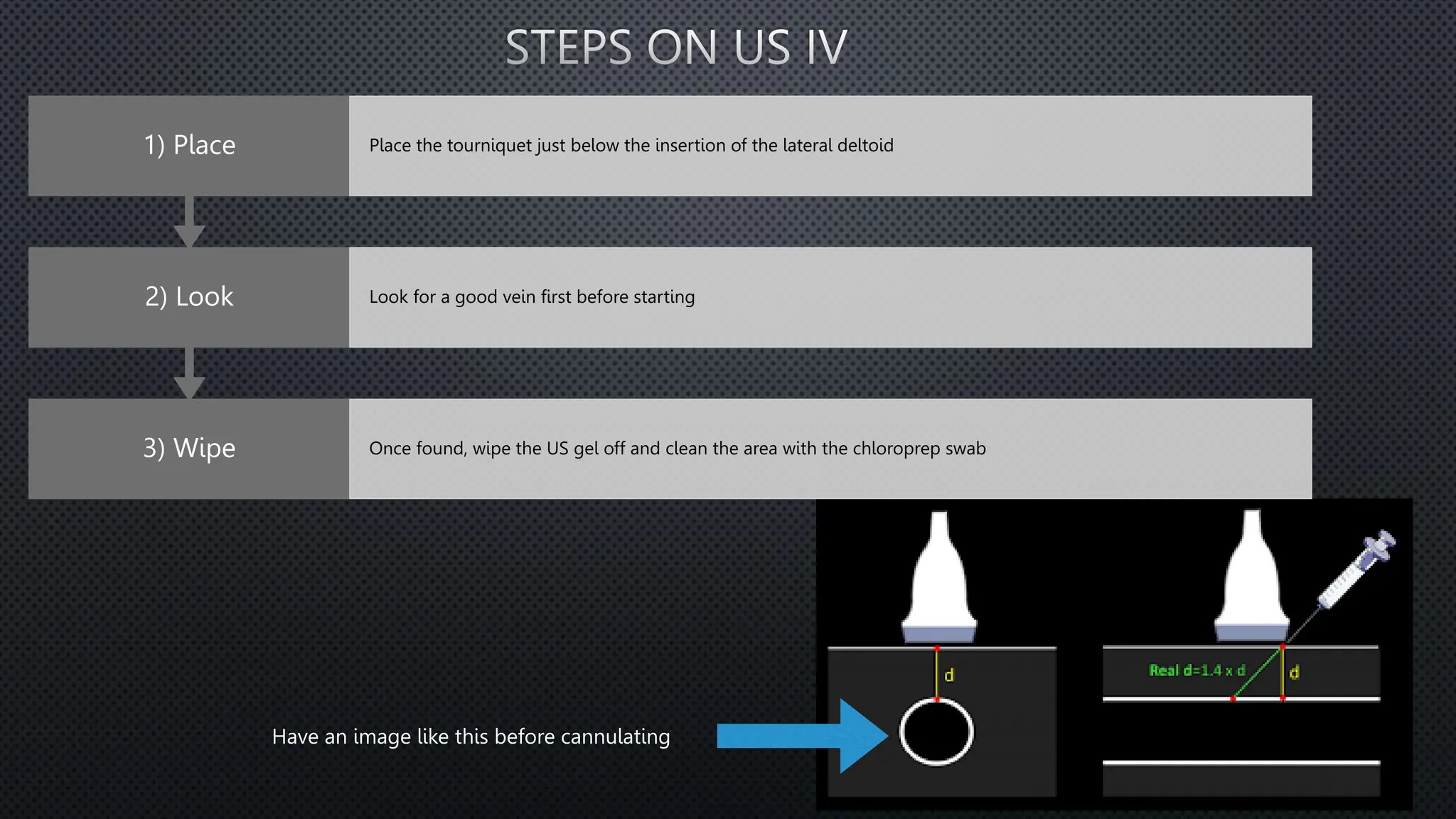 Peripheral IV placement under ultrasound guidance | PPTX