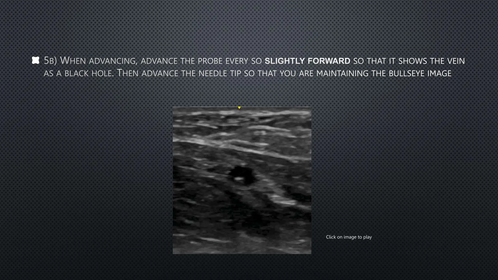 Peripheral IV placement under ultrasound guidance | PPTX
