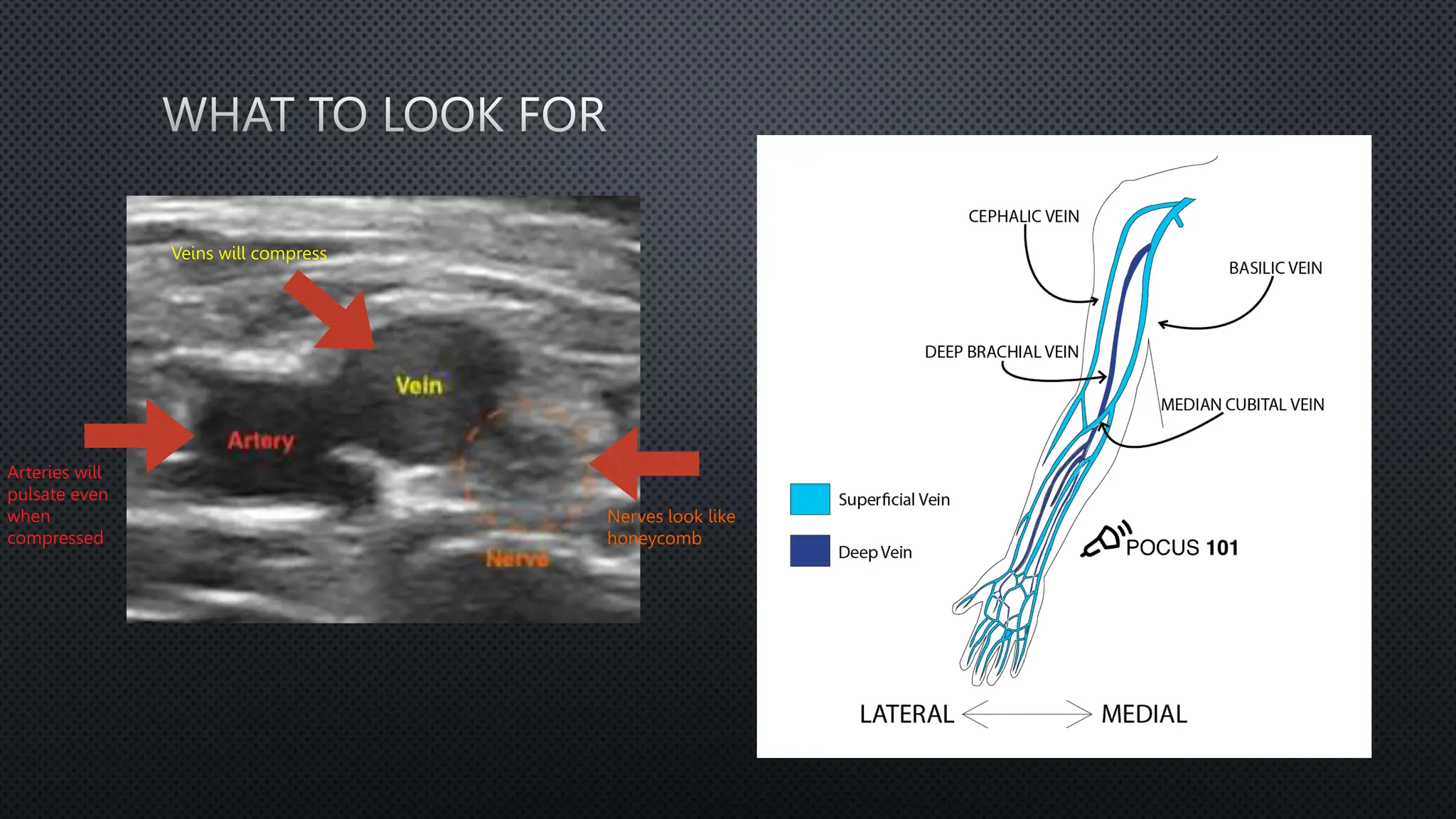 Peripheral IV placement under ultrasound guidance | PPTX
