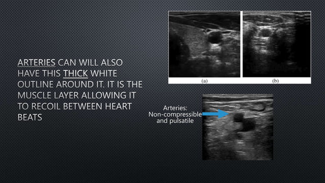 Peripheral IV placement under ultrasound guidance | PPTX