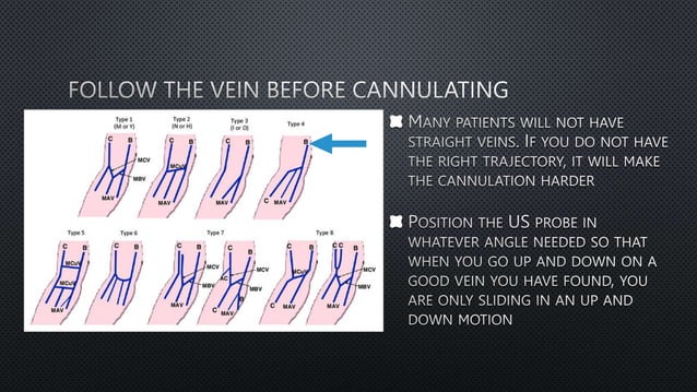 Peripheral IV placement under ultrasound guidance | PPTX