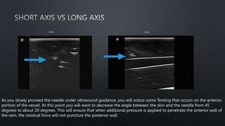 Peripheral IV placement under ultrasound guidance | PPTX