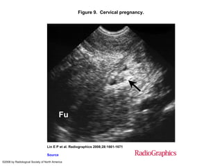 USS in Ectopic Pregnancy | PPT