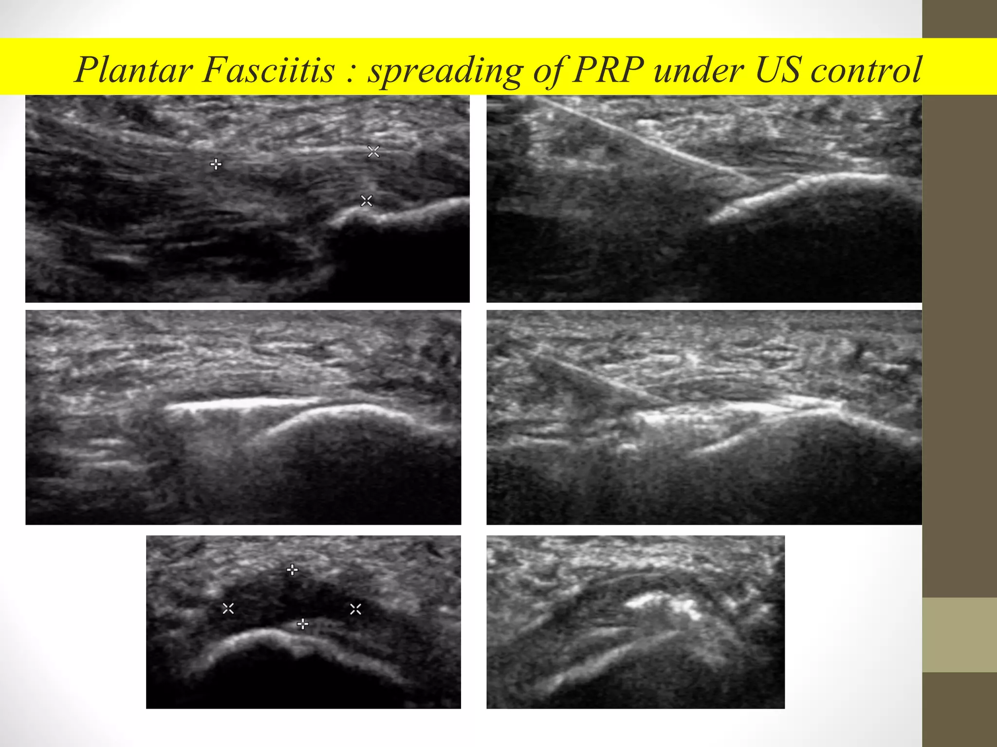 PRP Therapy for Tendonitis Fasciitis Acute Sprains and Muscular Lesions ...