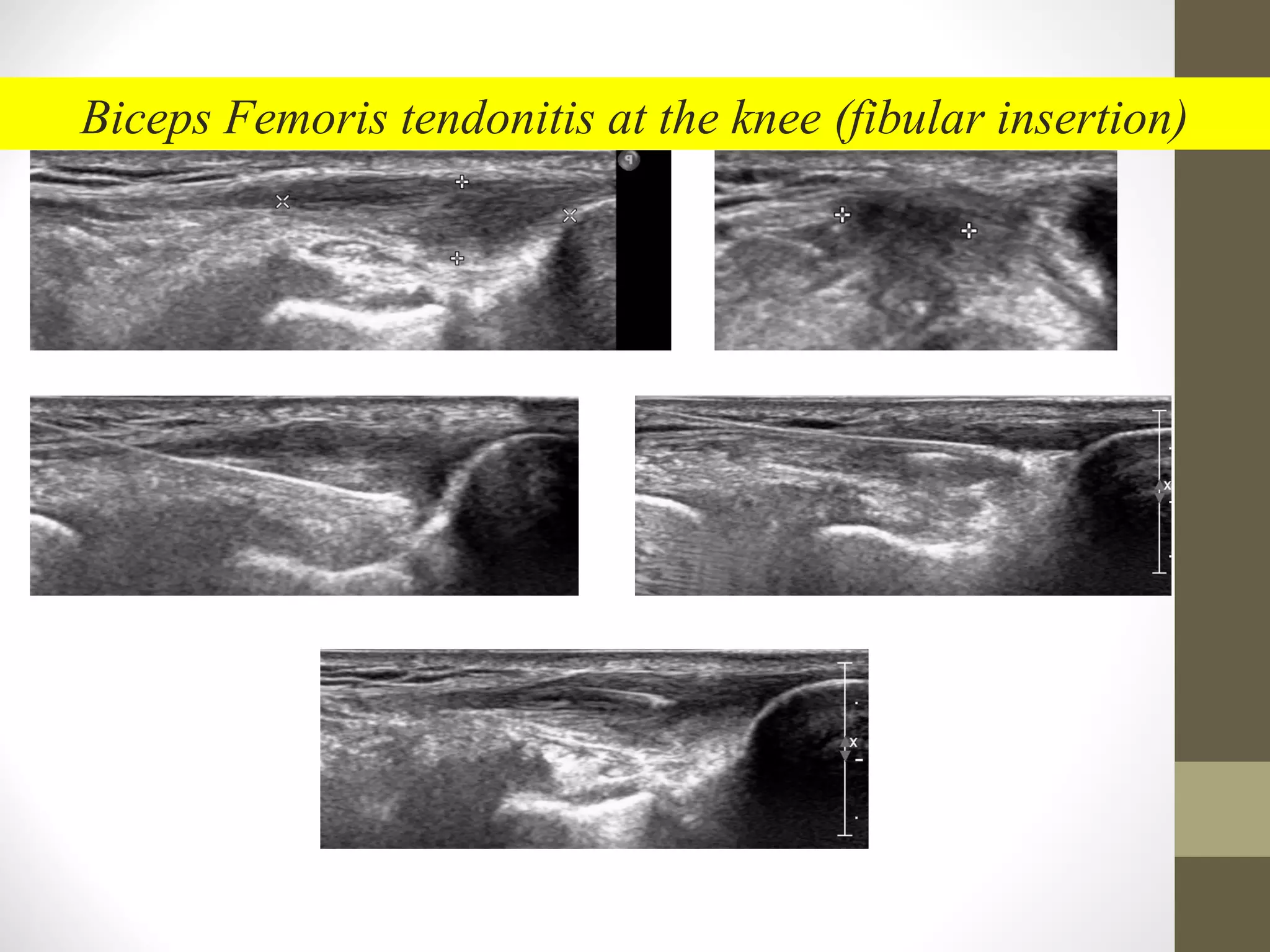PRP Therapy for Tendonitis Fasciitis Acute Sprains and Muscular Lesions ...