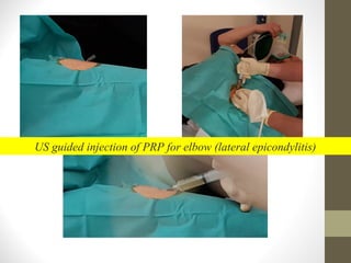 PRP Therapy for Tendonitis Fasciitis Acute Sprains and Muscular Lesions ...