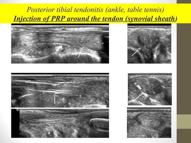 PRP Therapy for Tendonitis Fasciitis Acute Sprains and Muscular Lesions ...