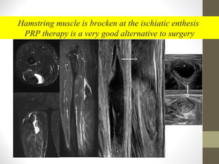 PRP Therapy for Tendonitis Fasciitis Acute Sprains and Muscular Lesions ...