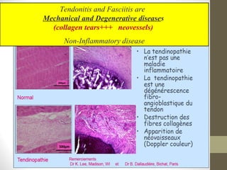 PRP Therapy for Tendonitis Fasciitis Acute Sprains and Muscular Lesions ...