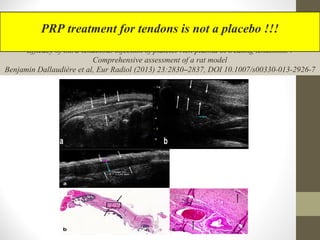 PRP Therapy for Tendonitis Fasciitis Acute Sprains and Muscular Lesions ...