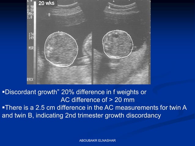 Ultrasonography of twin pregnancy SOGC GUIDELINE | PDF | Pregnancy ...