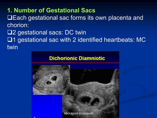 Ultrasonography of twin pregnancy SOGC GUIDELINE | PDF | Pregnancy ...