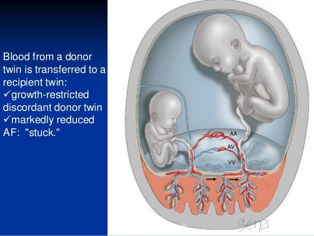 Ultrasonography of twin pregnancy SOGC GUIDELINE