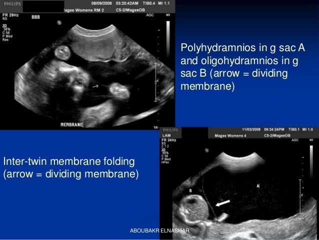 Ultrasonography of twin pregnancy SOGC GUIDELINE