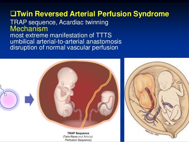 Ultrasonography of twin pregnancy SOGC GUIDELINE
