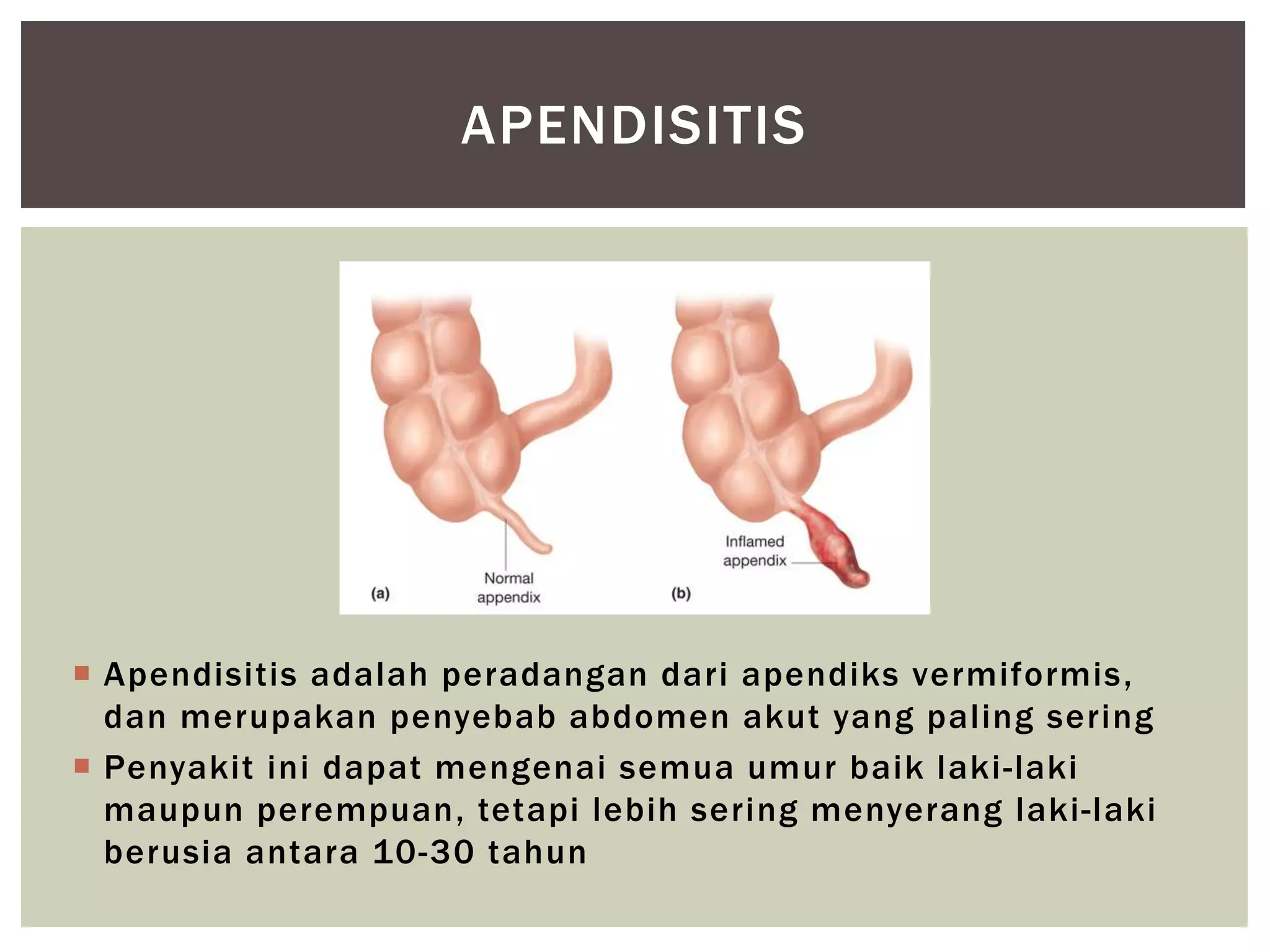 Usus-Buntu.ppt