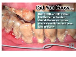 usv presentation.pptx | Dental Health | Diseases and Conditions