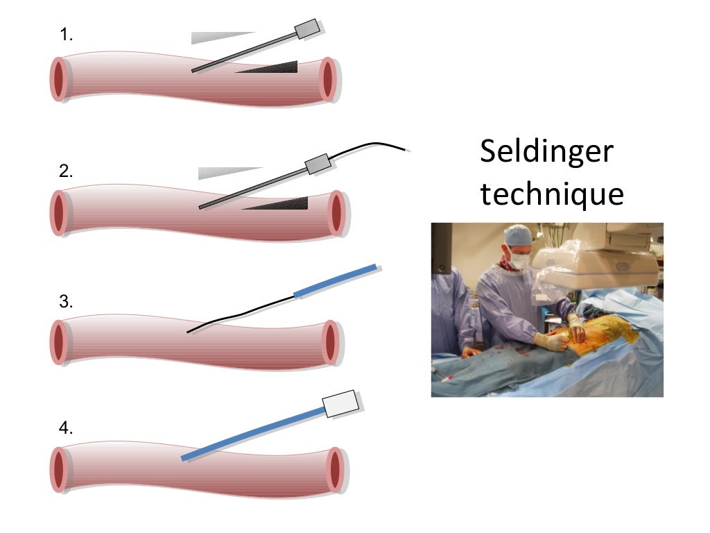 Uterine artery embolisation