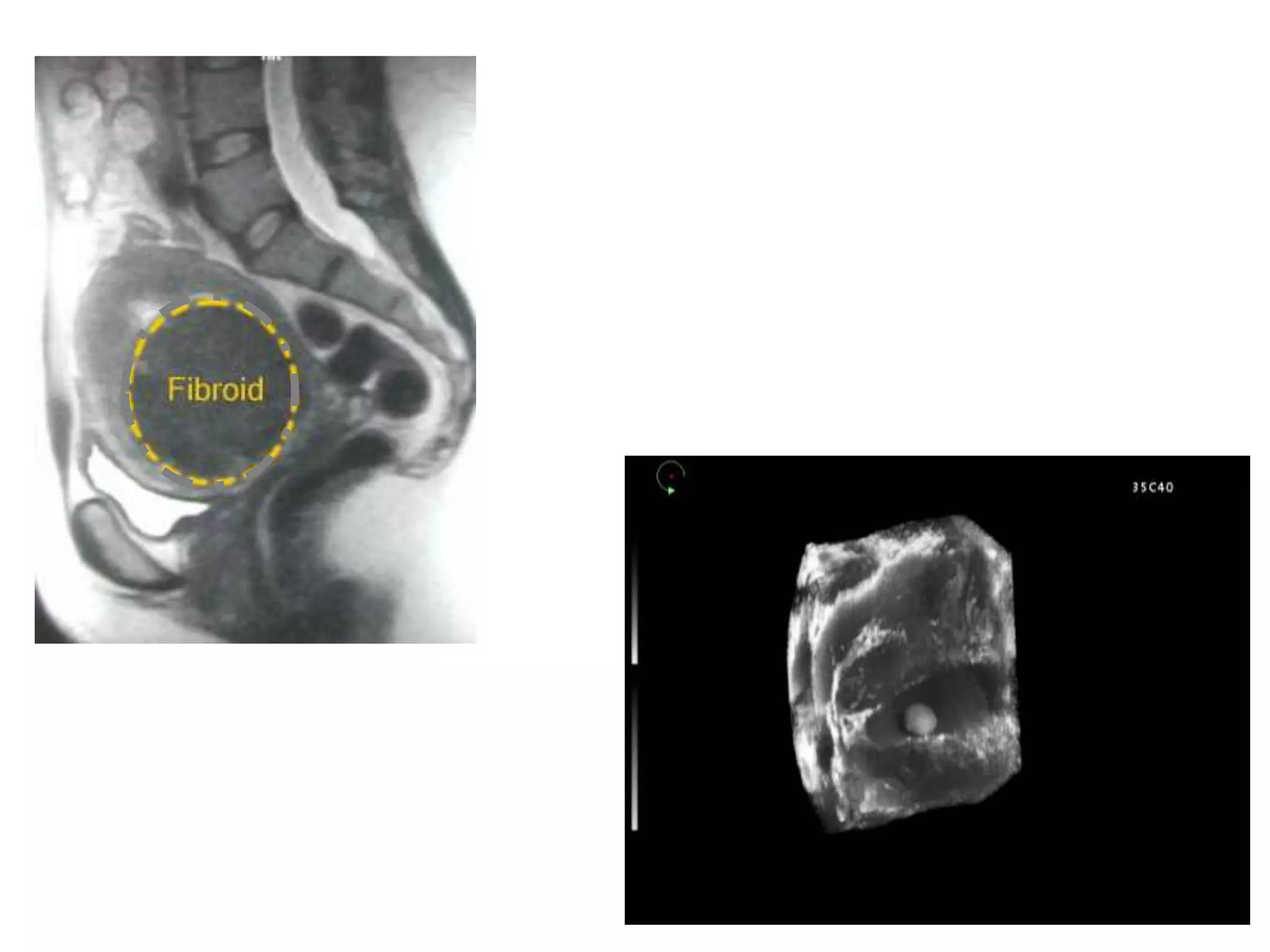 Uterine-Fibroids.ppt
