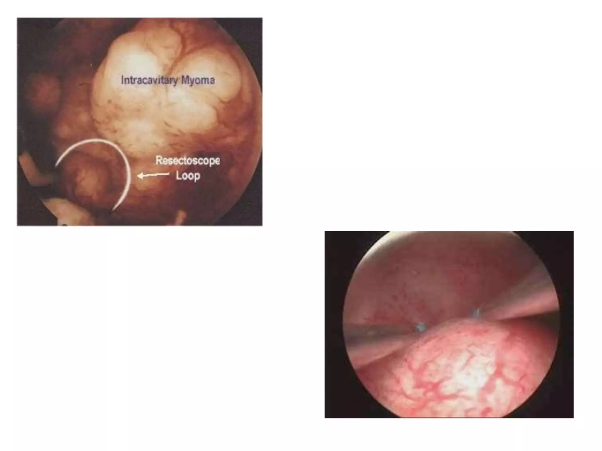 Uterine-Fibroids.ppt
