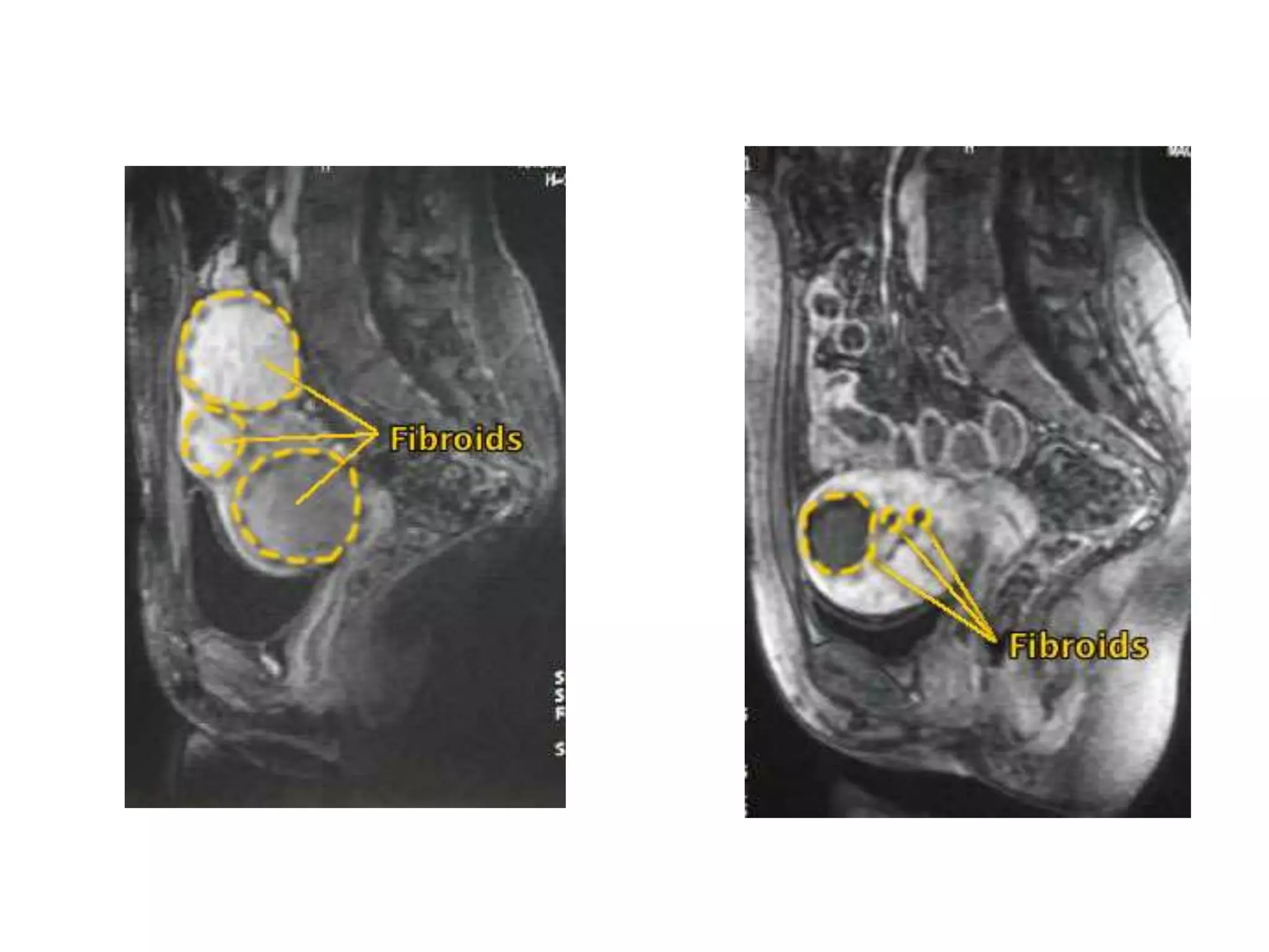 Uterine-Fibroids.ppt