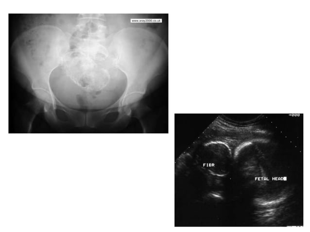 Uterine-Fibroids.ppt