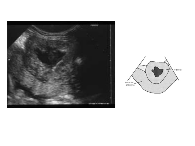 Uterine-Fibroids.ppt