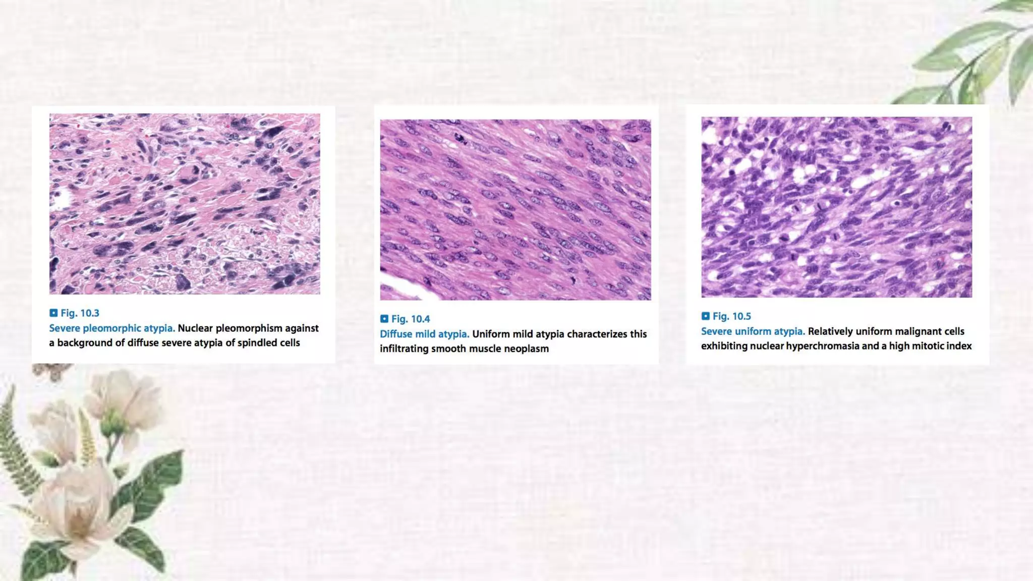Uterine Sarcomas - Testing | PPT