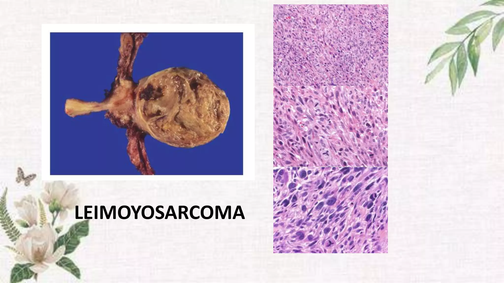 Uterine Sarcomas - Testing | PPT